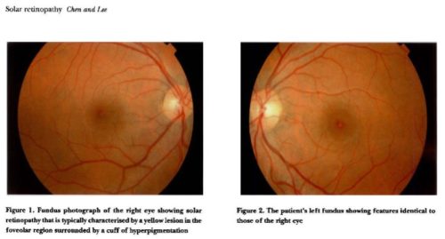 Solar Retinopathy: Why an Eclipse is So Dangerous, Especially for ...